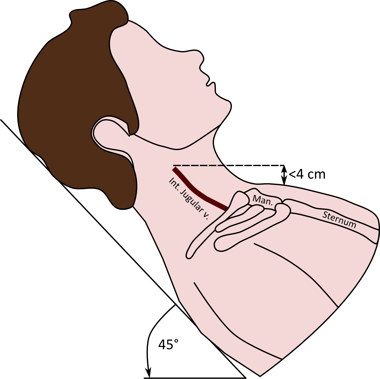 Flat Jugular Veins Photos - Jvp Angle Of Louis (1330x1326), Png Download