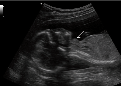 Fetal Goiter Ultrasound (618x463), Png Download