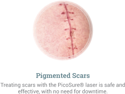 Download Pigmented-scars - Pigment | Transparent PNG Download | SeekPNG