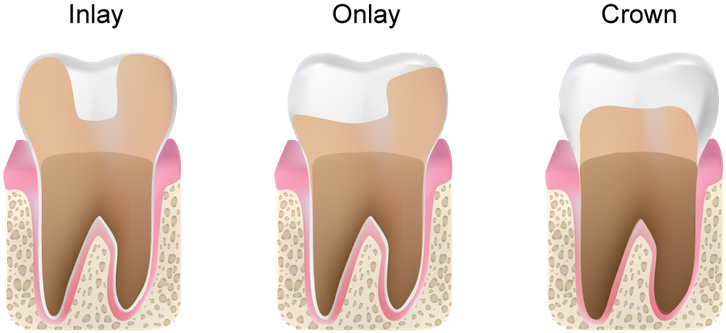 Porcelain Crowns Inlay Onlay - Inlays And Onlays (770x350), Png Download