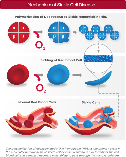 Description Of Sickle Cell Pathophysiology Medical - Sickle Cell ...