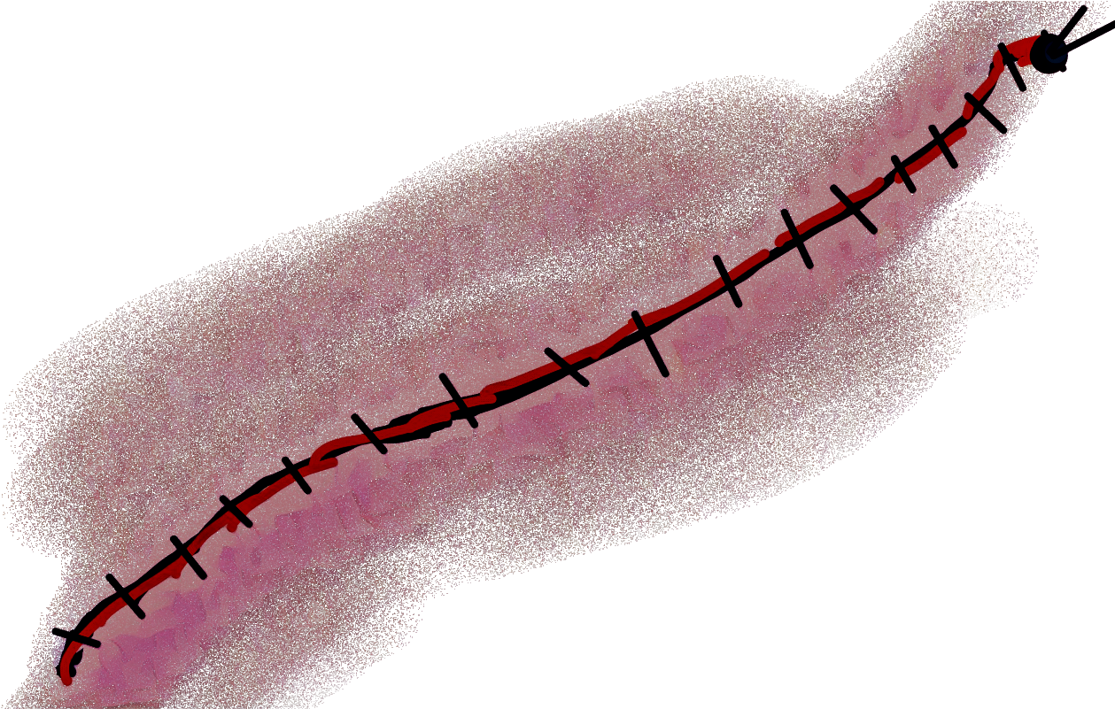 Black And White Scars Transparent Stitch - Scar Stitches Png (1280x800 ...