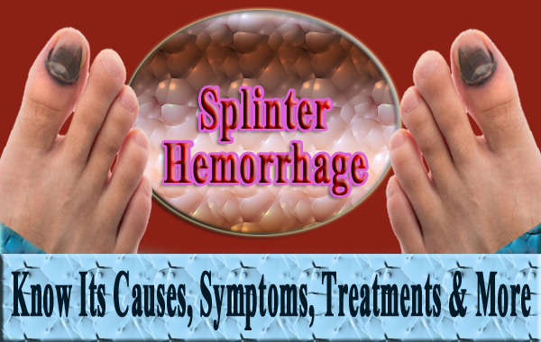 Splinter Hemorrhages Causes (600x380), Png Download
