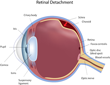 Download Retinal Detachment Austin, Texas - Retinal Detachment ...