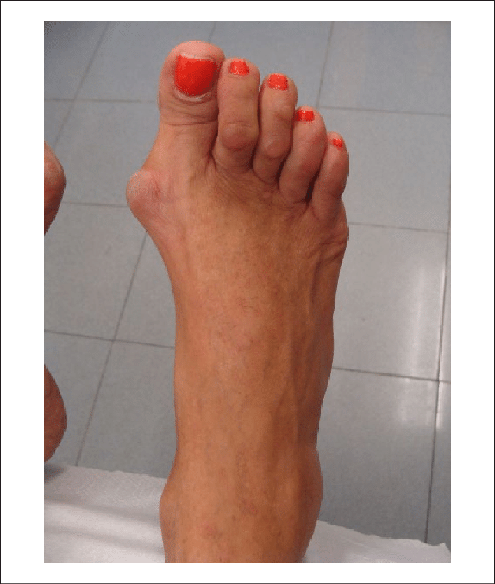 This Figure Shows A Very Common Deformity That Could - Toe (707x835 ...