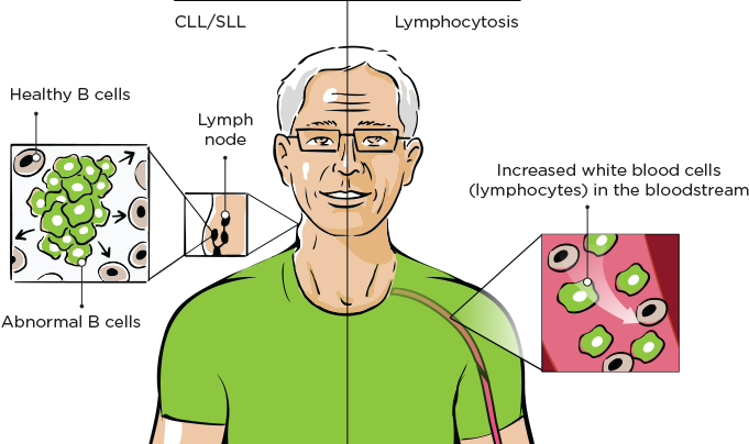 How Imbruvica® Works For Cll/sll - Cll Symptoms (681x404), Png Download