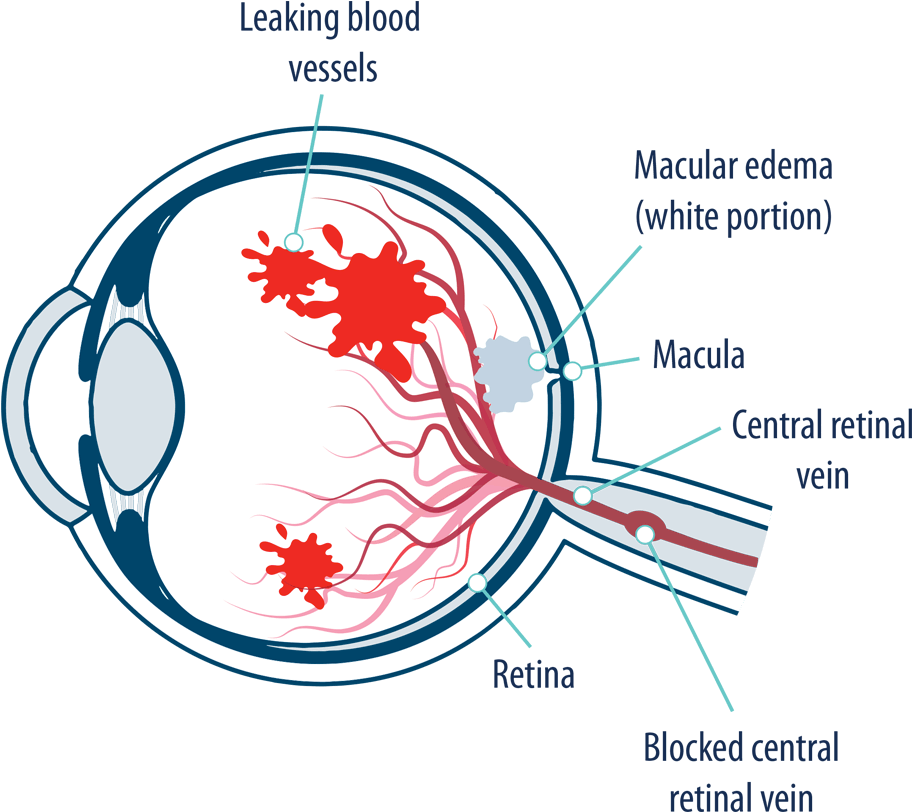 Download Eye With Macular Edema Following Retinal Vein Occlusion ...