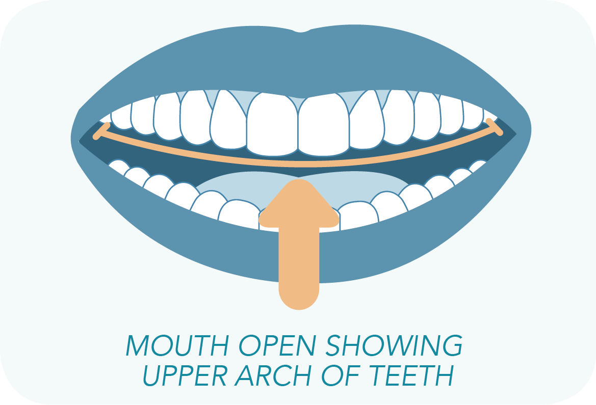 Mouth Open Showing Upper Arch Teeth - Mouth (1169x795), Png Download