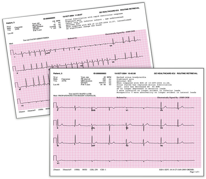 Ecg Analysis Sheets - Analysis (1092x800), Png Download