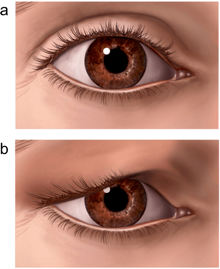 Illustration Showing A Normal Eyelid And Sagging Eyelid - Eye ...