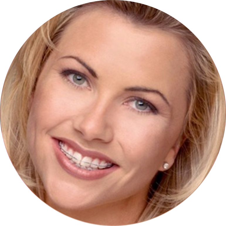 Download Ceramic Braces Are More Expensive Than Metal Braces ...