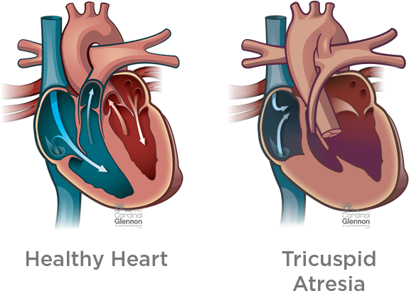 Download Hypoplastic Right Heart Syndrome - Truncus Arteriosus ...