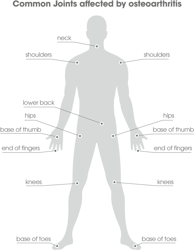Severe Osteoarthritis Of The Large Joints Like The - Man (650x835), Png ...