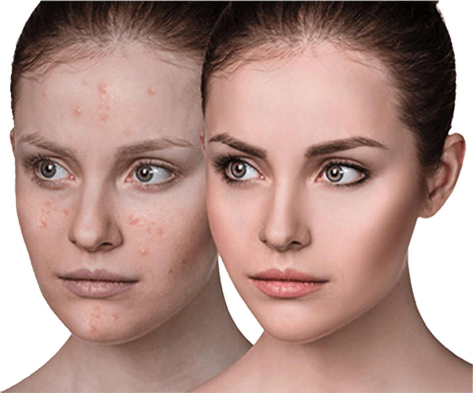 Acne Vulgaris Treatment - Mangosteen Skin Benefits For Cancer (1100x800 ...