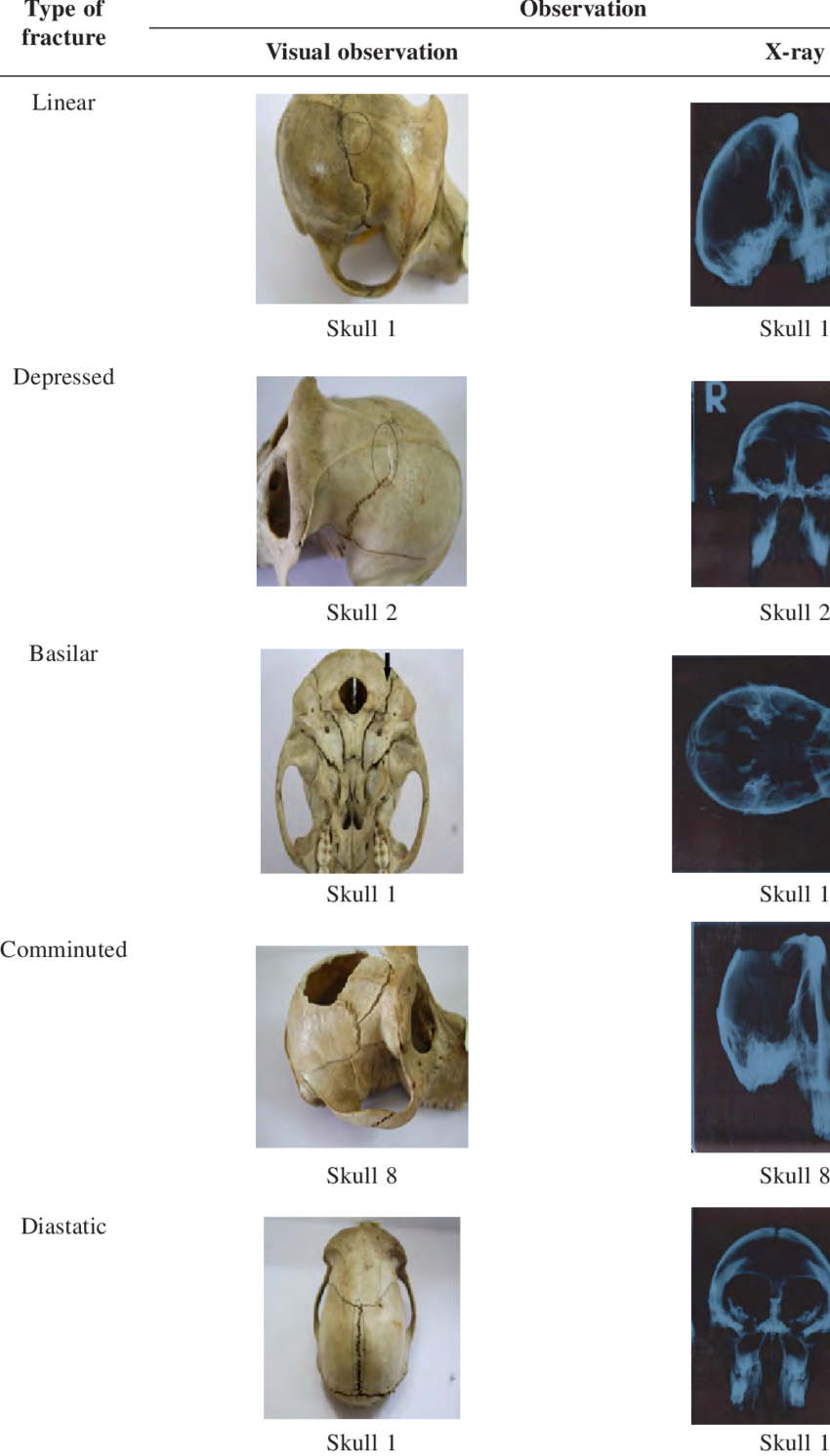 Download Types Of Skull Fractures Encountered - Skull Fracture Types ...