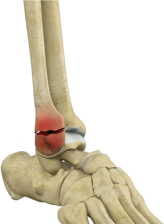 Transparent Broken Ankles (1280x720), Png Download