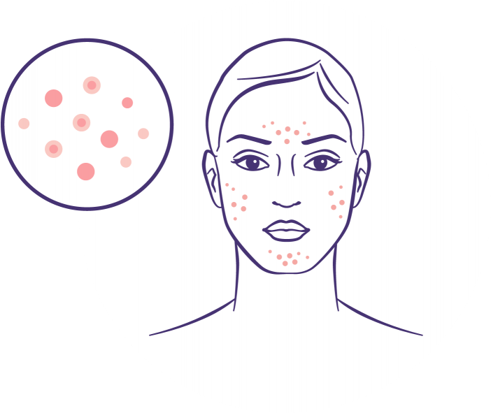 Acne - Face (716x600), Png Download