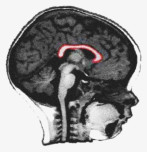 Download 1 - Corpus Callosum Baby Mri | Transparent PNG Download | SeekPNG