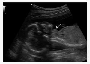 Fetal Goiter Ultrasound PNG Image | Transparent PNG Free Download on ...