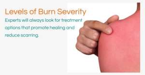 Levels Of Burn Severity - Sunburned Skin PNG Image | Transparent PNG ...