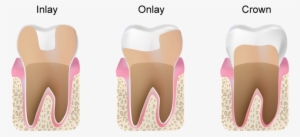 Inlay - Number PNG Image | Transparent PNG Free Download on SeekPNG