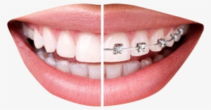 Braces Png PNG Images | PNG Cliparts Free Download on SeekPNG