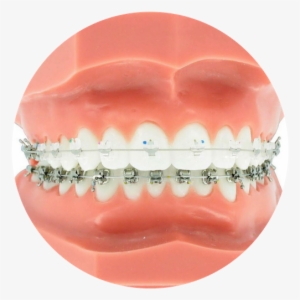 Clear Braces PNG Image | Transparent PNG Free Download on SeekPNG