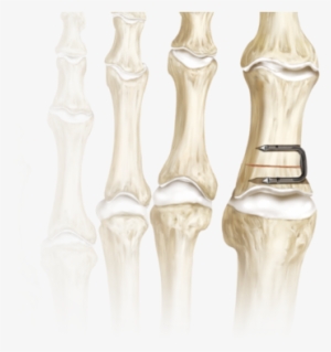 Quickfix Staple System 0 Large - Staple In Foot Bone Surgery PNG Image ...