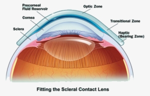 Scleral Contact Lenses - Intravitreal Injection PNG Image | Transparent ...