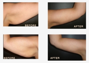 Arm34 - Arm Lift 6 Month Post Op PNG Image | Transparent PNG Free ...