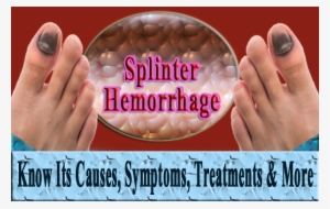 Splinter Hemorrhages Causes PNG Image | Transparent PNG Free Download ...