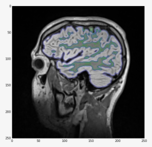 Label Overlay Showing Both White And Gray Matter As - Grey Matter PNG ...