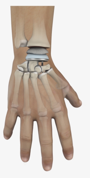Wrist Joint Replacement - Joint Replacement PNG Image | Transparent PNG ...
