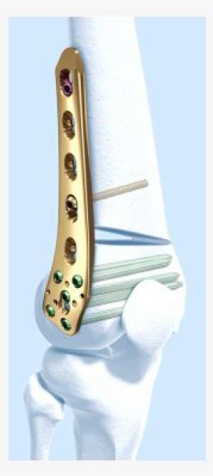 Tomofix Lateral Distal Femur Plate With Screws In Bone - Femur PNG ...
