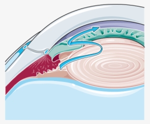 Angle-closure Glaucoma - Eye PNG Image | Transparent PNG Free Download ...