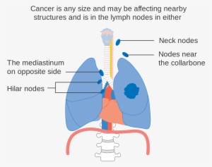 Open - Lung Cancer PNG Image | Transparent PNG Free Download on SeekPNG