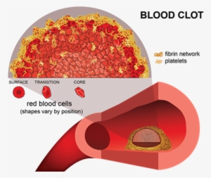 Researchers Look Inside Dangerous Clots With Optical - Blood Clotting ...
