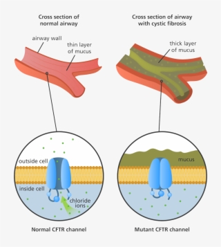 An Illustration To Show Normal And Mutant Cftr Channels, - Cftr Cystic ...