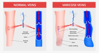 Open Skin Ulcers - Disease Of The Vascular System PNG Image ...
