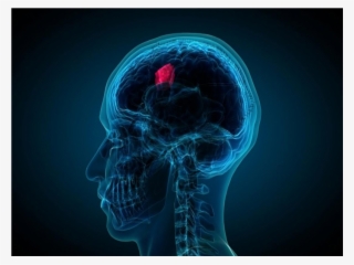 Brain Tumor PNG Image | Transparent PNG Free Download on SeekPNG