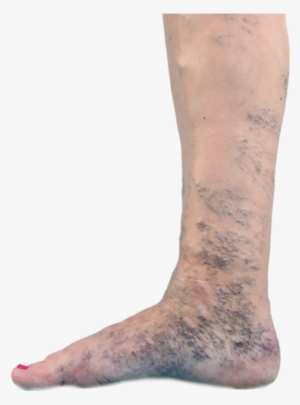 Varicose Veins PNG Image | Transparent PNG Free Download on SeekPNG
