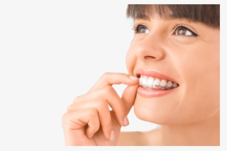Invisalign Download PNG Image | Transparent PNG Free Download on SeekPNG