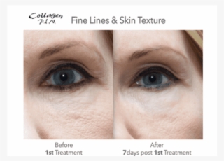 Before And After - Microneedling Fine Lines Before And After PNG Image ...
