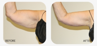 This Surgical Procedure Reduces Sagging Excess Skin - Upper Arms PNG ...