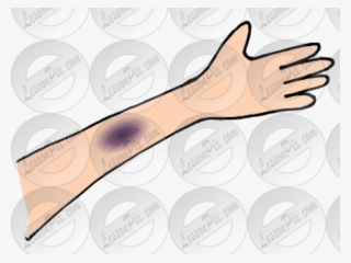 Bruise Clipart Black And White PNG Image | Transparent PNG Free ...