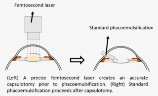 What Is Laser-assisted Cataract Surgery - Diagram PNG Image ...